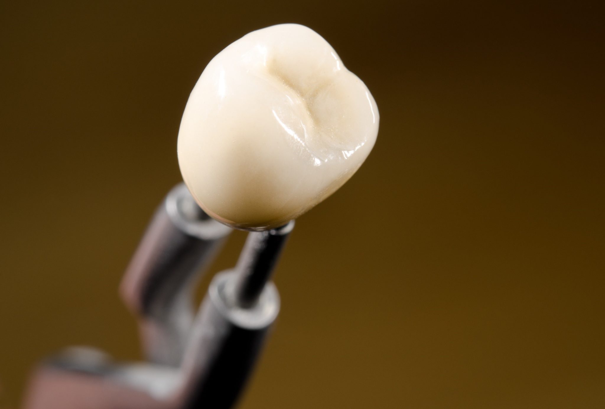 Factors Affecting the Lifespan of Dental Crowns